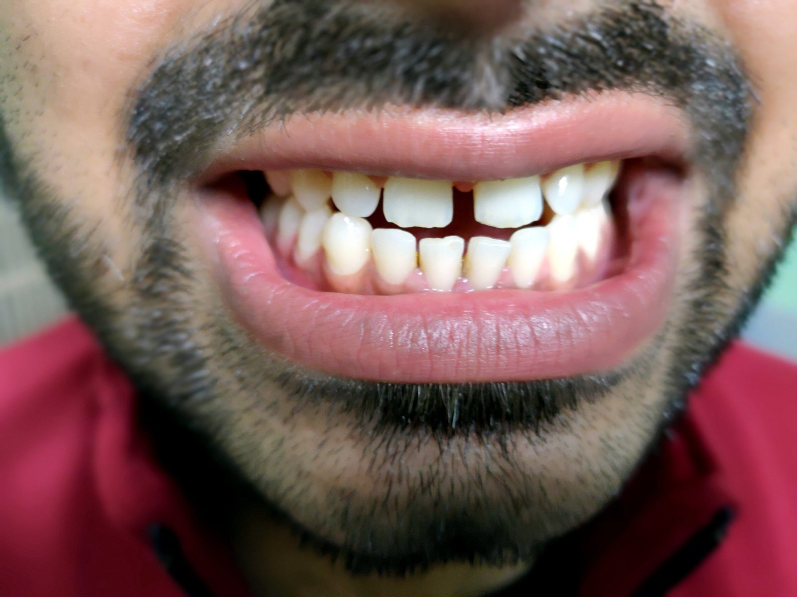 Dientes Separados ViardenLab Dientes Separados ViardenLab